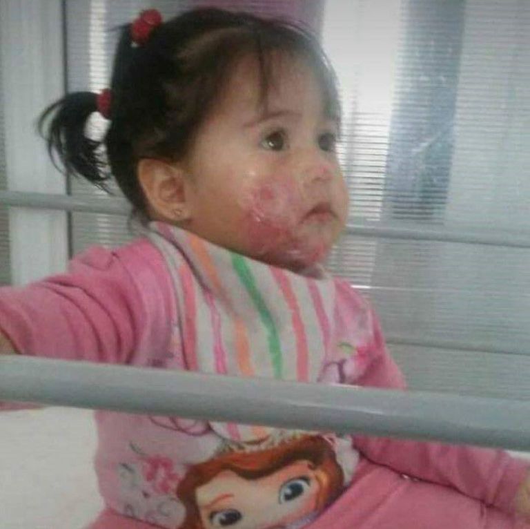 Cumple 1 año, y espera una máscara por una quemadura que sufrió en el ...